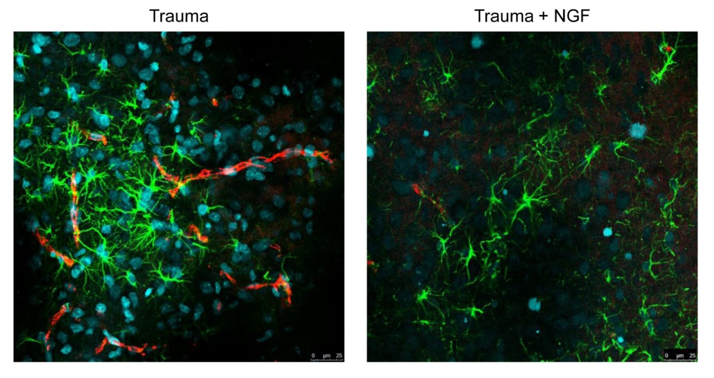 La molecola NGF per limitare i danni cerebrali