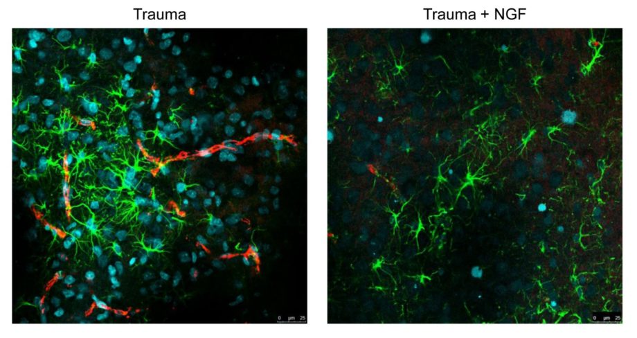 La molecola NGF per limitare i danni cerebrali